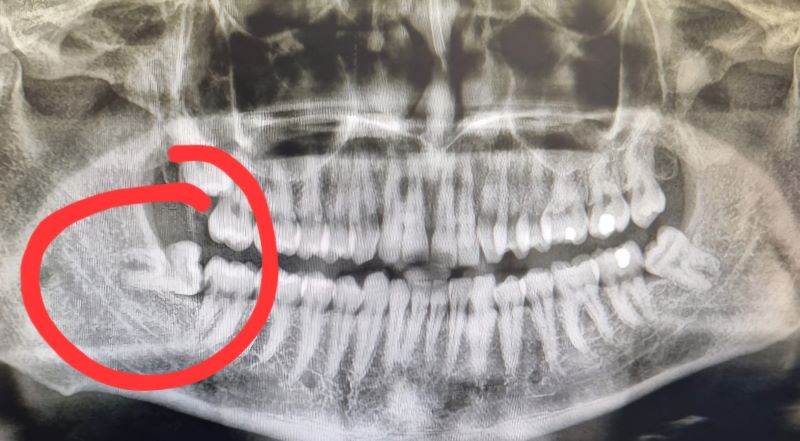 Why Do Wisdom Teeth Grow Sideways? Learn the Answer Here